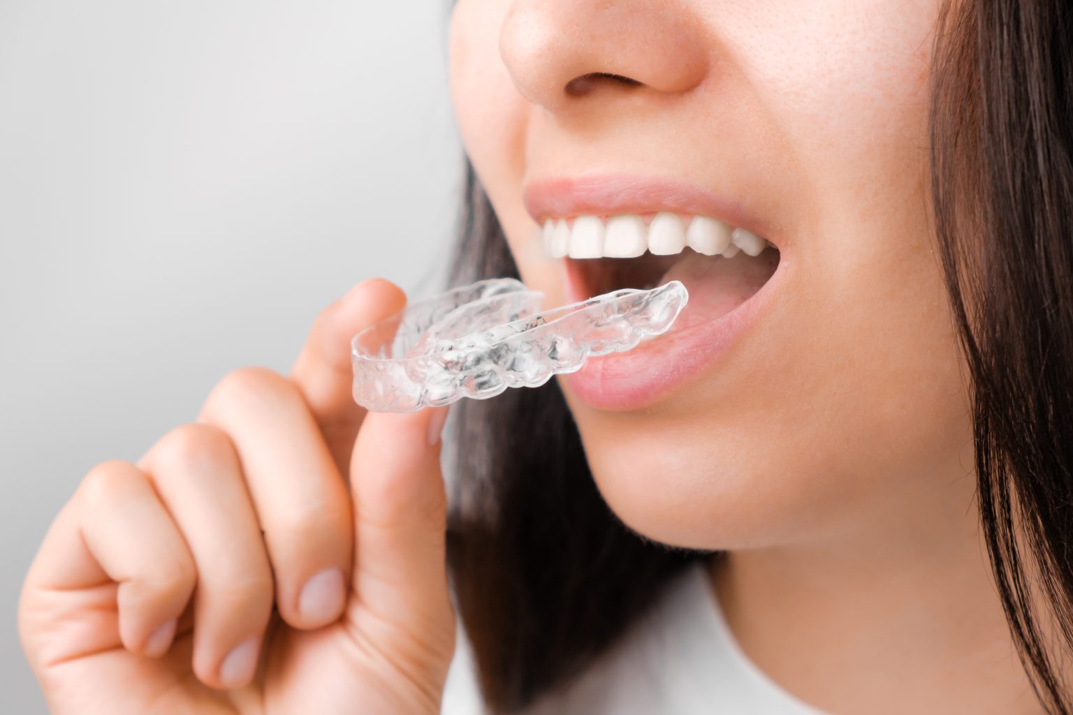 Invisalign – Dilan Dent